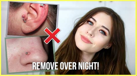 How To Get Rid Of A Granuloma Treating Pyogenic Granuloma
