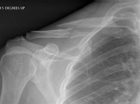 Mal United Clavicle Non Union Fracture Dr David Duckworth