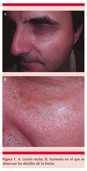 Liquen escleroso extragenital de manifestación facial Dermatología