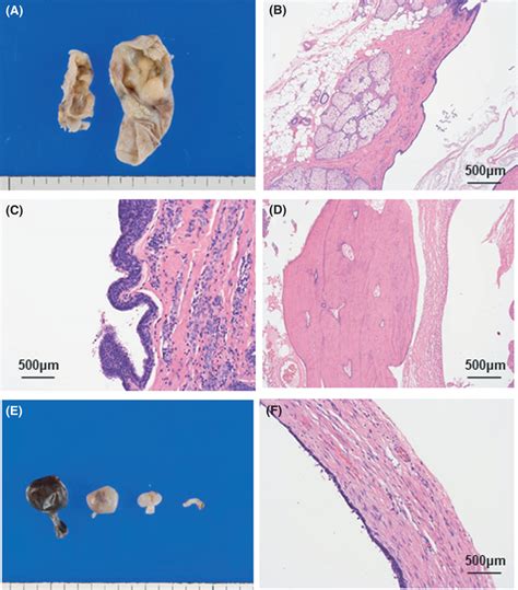 Macroscopic And Pathological Findings A Macroscopic Findings Of