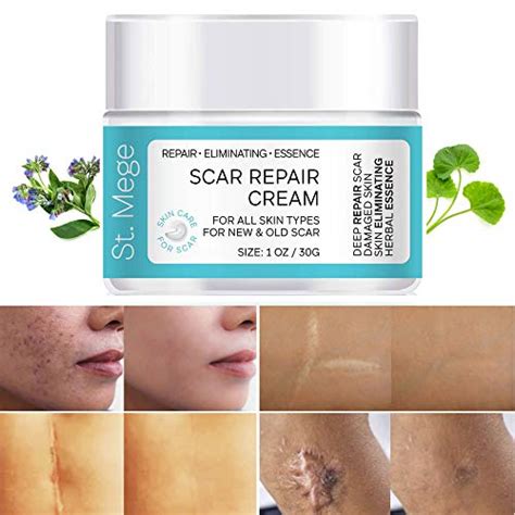 Best Acne Scar Removal Cream In Dubai At William Corey Blog