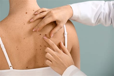 Cancer de la peau la méthode ABCDE pour le repérer soi même