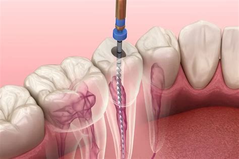 Cómo saber si necesito empaste o endodoncia Clinica FL Dental FL Dental