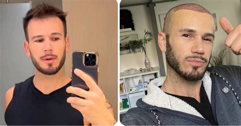 Isola Dei Famosi Matteo Diamante Ha Fatto Il Trapianto Di Capelli