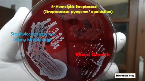 Beta Haemolytic Colonies Of Staphylococcus Aureus And Streptococci On