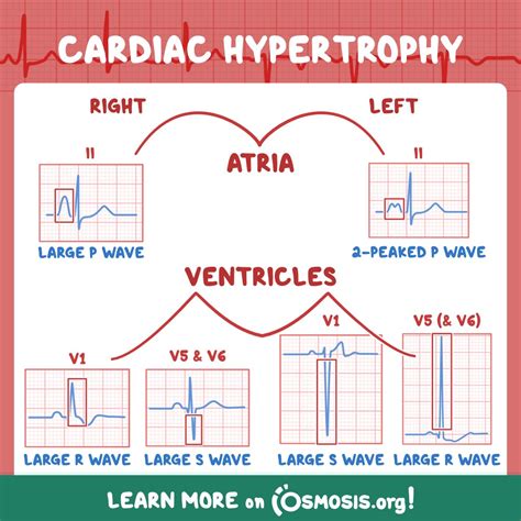 Rishi Desai On Twitter OsmosisMed It S Mondaytime For Another ECG