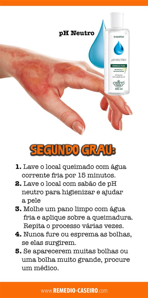 Pomada Para Queimadura Caseira E Primeiros Socorros
