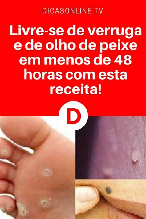 Saiba Como Remover Olho De Peixe M Todos Naturais Em Olho