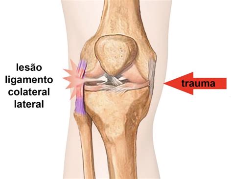 Ligamento Colateral Lateral Do Joelho Dr Pedro Giglio