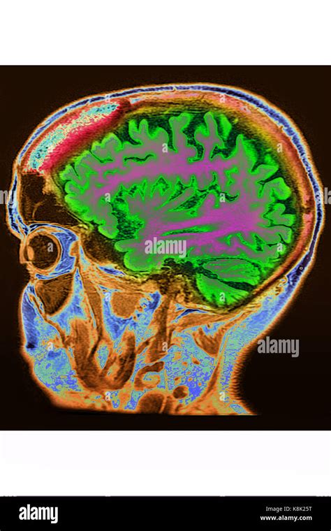 CEREBRAL ATROPHY MRI Stock Photo Alamy