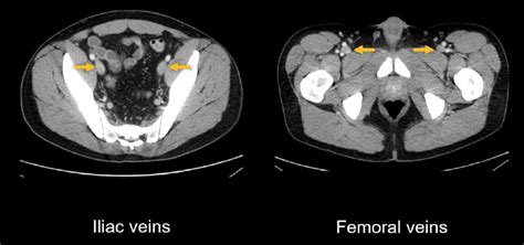 Abdominal Ct Abdominal Veins • Litfl • Radiology Library