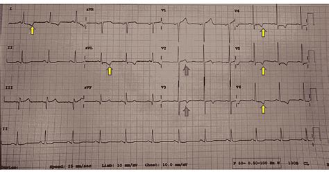 Wellens Syndrome A Rare Case Cureus