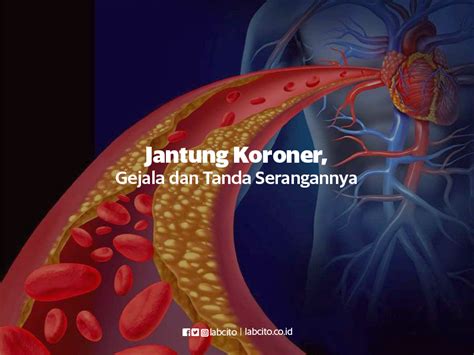 Gejala Jantung Koroner Apa Yang Harus Diwaspadai