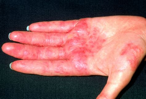 Atopic Dermatitis Hands Treatment