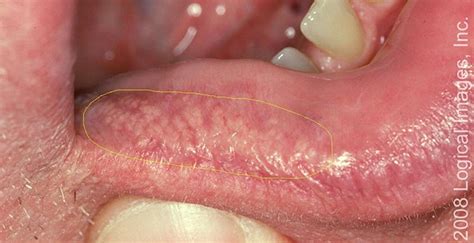 Fordyce Spots On Penis