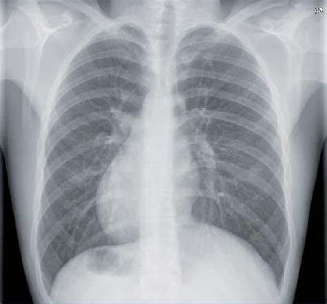 Cómo se debe interpretar una radiografía de tórax Saludiario