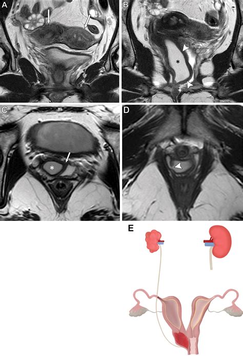 Müllerian Duct Anomalies Role in Fertility and Pregnancy RadioGraphics