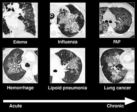 Imaging Pulmonary Infection Classic Signs And Patterns AJR