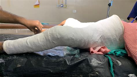 Hip Spica Cast For Femur Fracture In A 3 Year Kid Thighbone Fracture