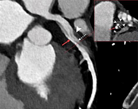 Spontaneous Coronary Artery Dissection Radiology