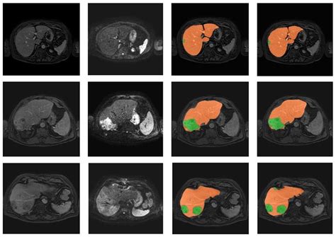 three examples of liver and metastases segmentations from left to download scientific diagram