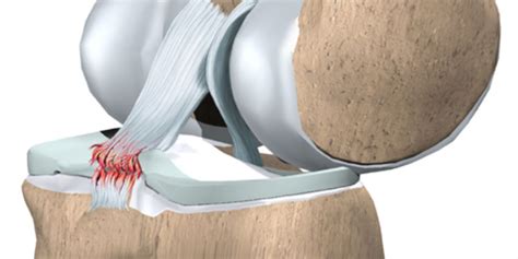 Why Posterior Cruciate Ligament Injuries Rarely Require Surgery Nation