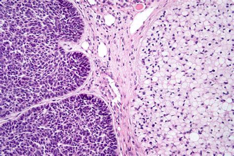 Pathology Outlines Basal Cell Carcinoma