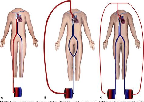 The Utility Of Parallel Venovenous Extracorporeal Membrane Oxygenation