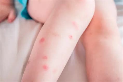 Cómo identificar qué insecto te ha picado mosquito avispa