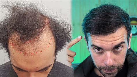 Transplante Capilar FUE de A a Z Preços Procedimento e Evolução até