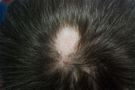 Alopecia Areata Cauze Si Tratament Dr Mihai Lupu