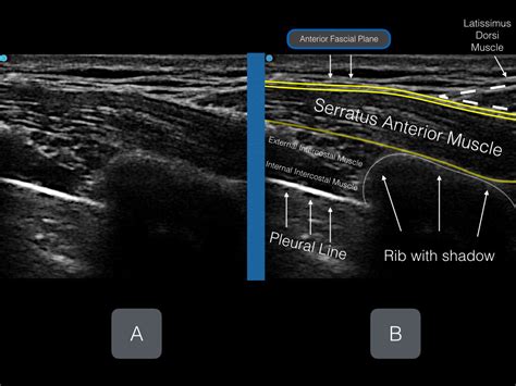 Serratus Anterior Plane EASY Highland EM Ultrasound Fueled Pain