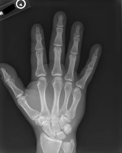 Mi Hand And Wrist Flashcards Quizlet