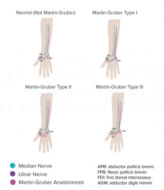 Ulnar Nerve Lesions Causes Diagnosis Ulnar Nerve Mi Pro Co Uk