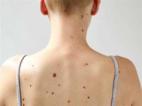 Cancerous Mole Vs Normal Mole