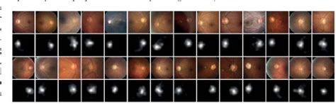 figure 1 from implementation of convolutional neural network for predicting glaucoma from fundus