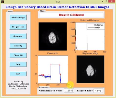 brain tumor detection on dicom images using rough set theory matlab project with source code