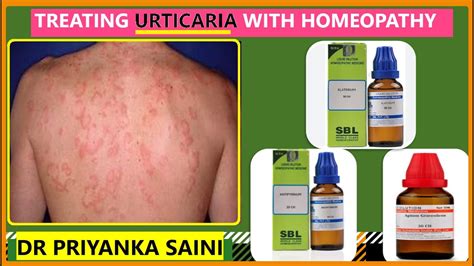 Urticaria Homeopathic Treatment For Urticaria Skin Itch Burning