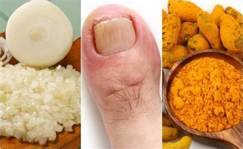 C Mo Preparar Remedios Caseros Para Aliviar Los U Eros Mejor Con Salud