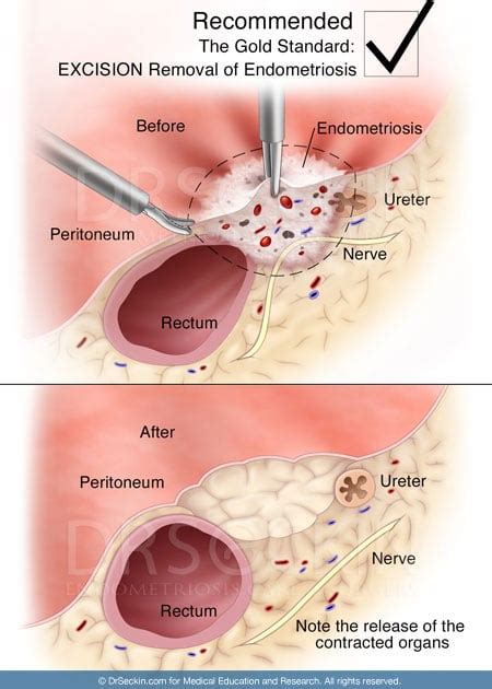 Excision Surgery Endometriosis Endometriosis Excision Surgery