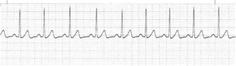 Ekg Strips Flashcards Quizlet