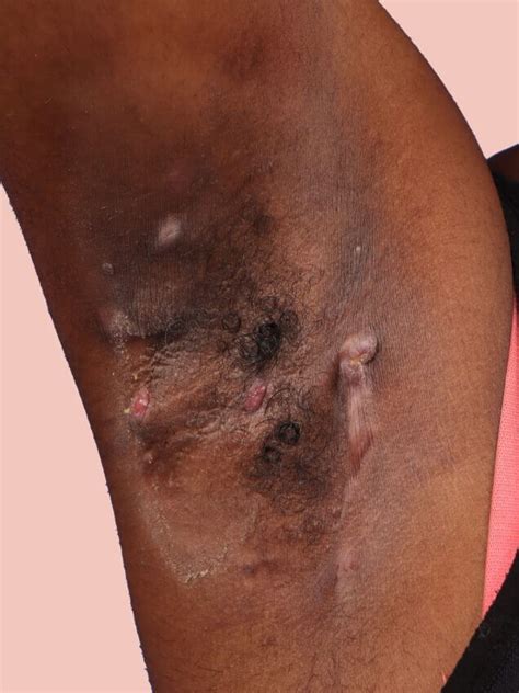 Hidradenitis Suppurativa Early Recognition And Treatment By Primary