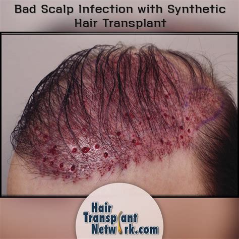 Bad Scalp Infection With Synthetic Hair Transplant Hair Transplant