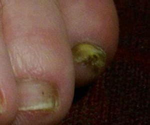 Onicomicosis Hongos En Las U As De Los Pies Dra Lorea Bagazgoitia