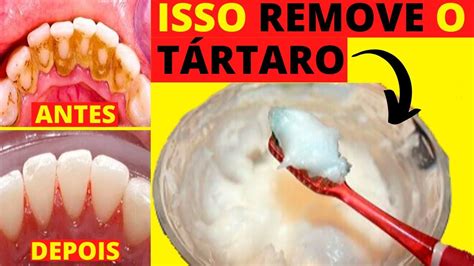 Como REMOVER o TÁRTARO dos DENTES em Casa e ter DENTES BRANCOS YouTube