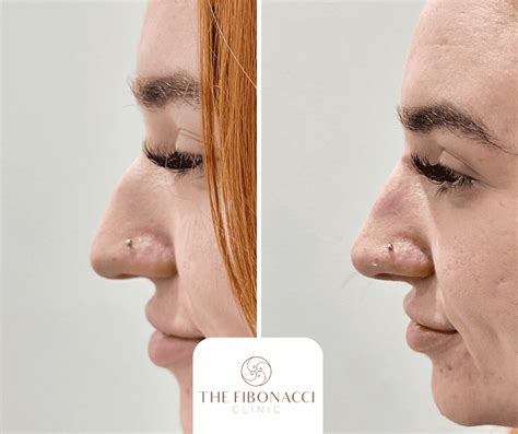 Nose Filler Non Surgical Nose Job Rhinoplasty The Fibonacci Clinic