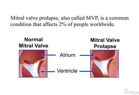 Mitral Valve Prolapse Symptoms Causes And Treatment 48 OFF