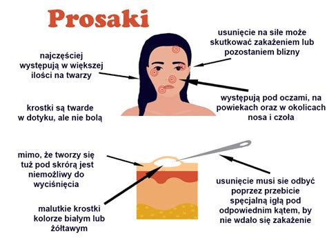 Prosaki na twarzy czym są jak rozpoznać jak się ich pozbyć