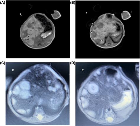 Coronal T1 Weighted Magnetic Resonance Imaging MRI A B Coronal