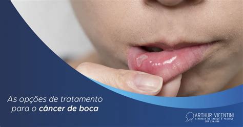 As Opções De Tratamento Para O Câncer De Boca Dr Arthur Vicentini